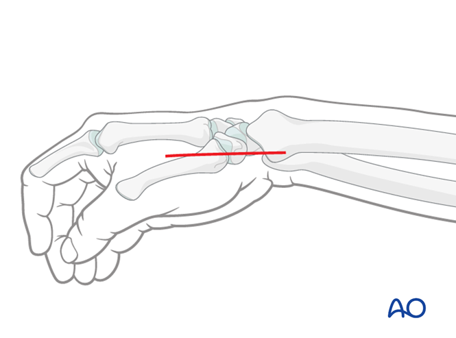 Direct approach to the radial styloid