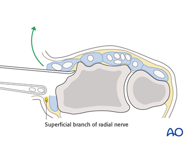 Direct approach to the radial styloid