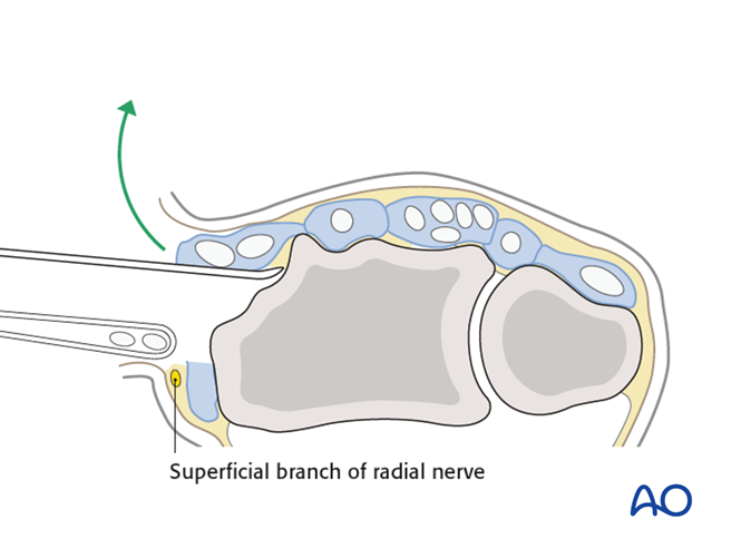 Direct approach to the radial styloid