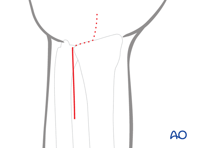 Ulnar palmar approach to the distal radius