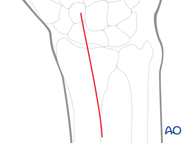 Dorsal approach to the distal forearm