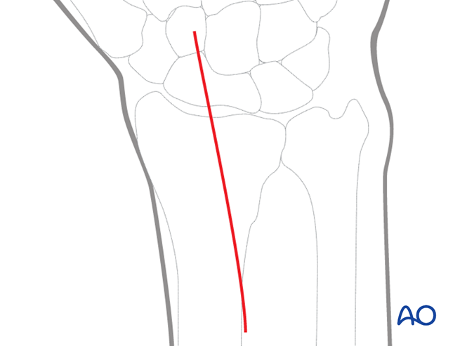 Dorsal approach to the distal forearm