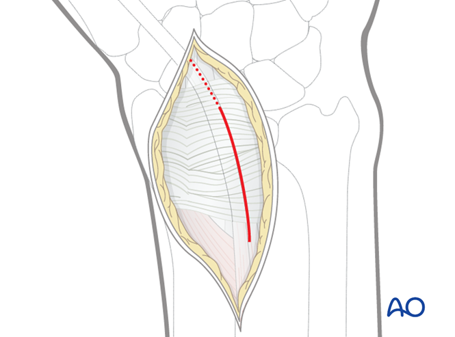 Dorsal approach to the distal forearm