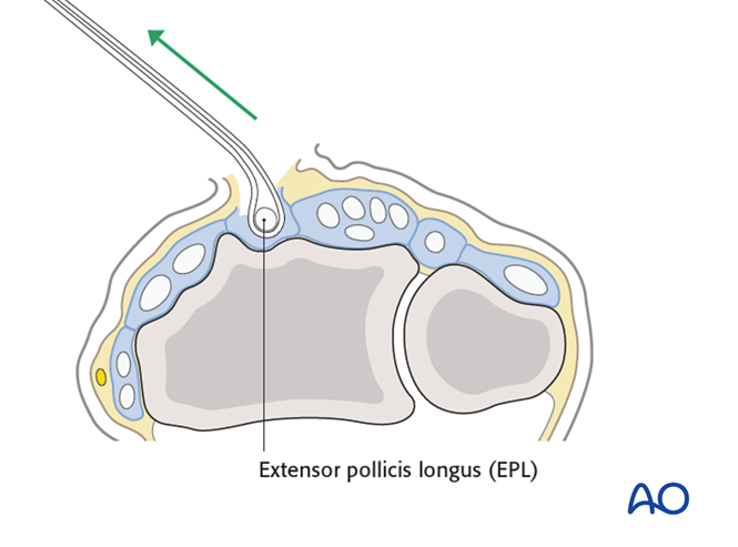 Dorsal approach to the distal forearm for joint spanning plate