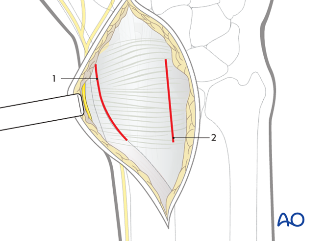 Dorsal approach to the distal forearm
