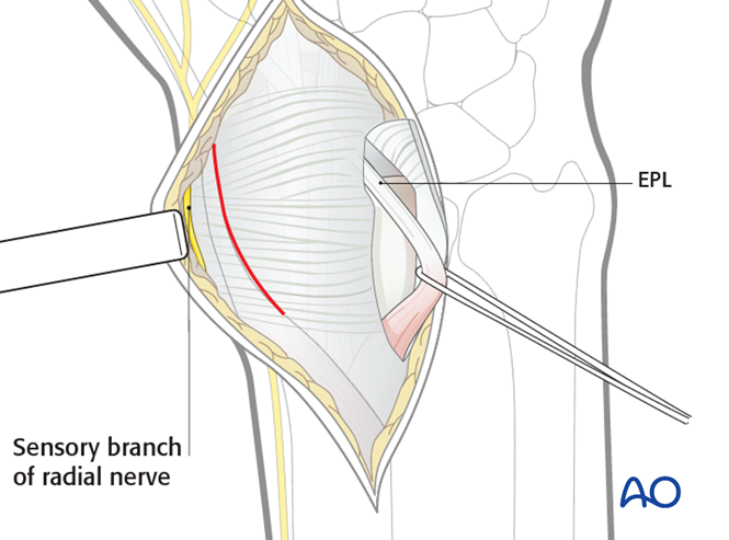 Dorsal approach to the distal forearm