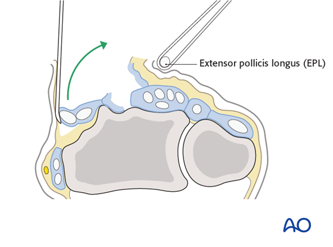 Dorsal approach to the distal forearm