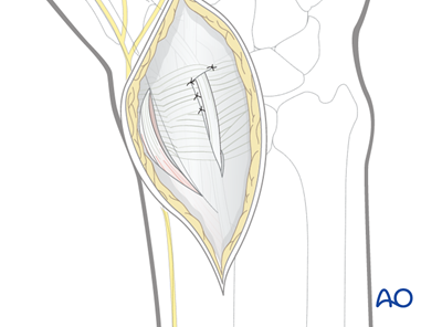 Dorsal approach to the distal forearm