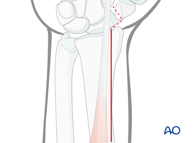 Palmar approach – modified Henry approach to the distal forearm