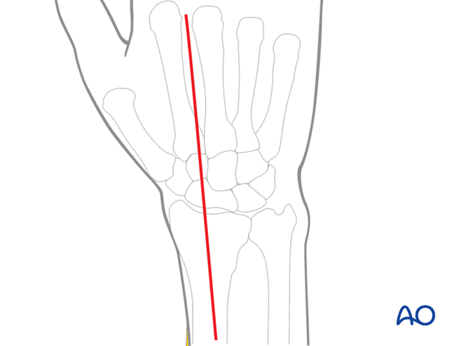 Dorsal approach for joint spanning plate