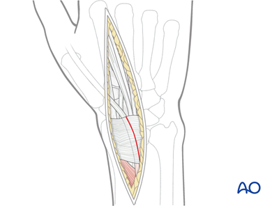 Dorsal approach to the distal forearm for joint spanning plate