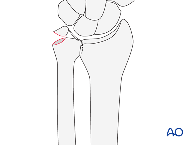 Extraarticular fracture of the ulnar styloid process