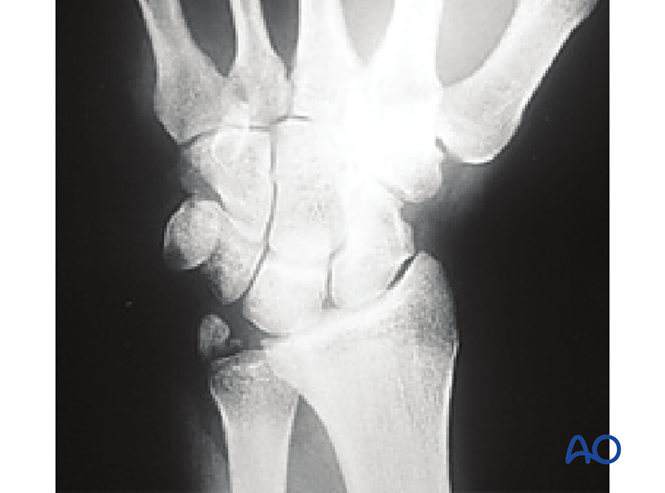 Extraarticular fracture of the ulnar styloid process