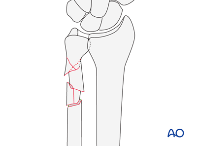 Extraarticular multifragmentary fracture of the ulna
