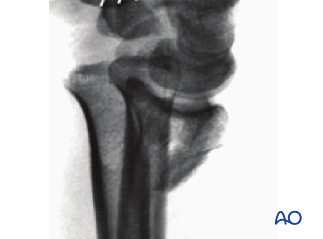 Partial articular, simple fracture of the radius, involving the dorsal ...