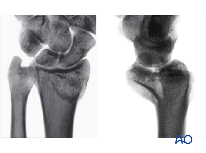 Partial articular fracture of the radius, involving the volar rim ...