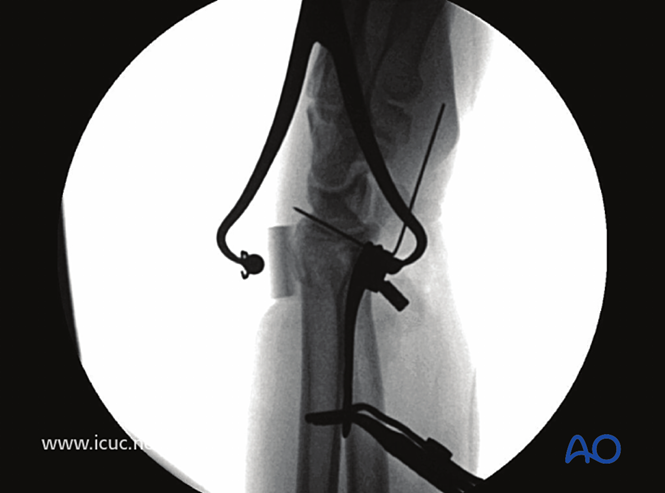 ORIF - Palmar bridge plate for Extraarticular wedge or multifragmentary ...