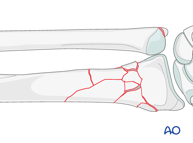 ORIF - Palmar bridge plate for Extraarticular wedge or multifragmentary ...