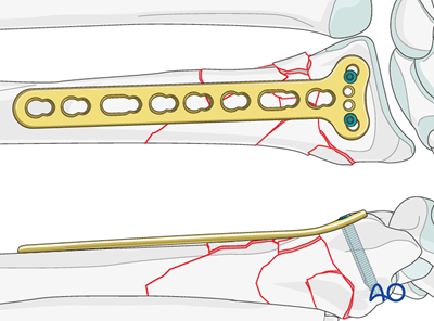 ORIF - Palmar bridge plate for Extraarticular wedge or multifragmentary ...