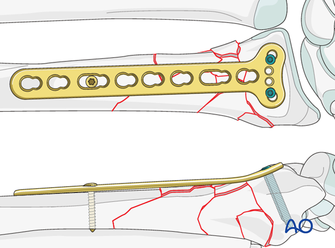 ORIF - Palmar bridge plate for Extraarticular wedge or multifragmentary ...