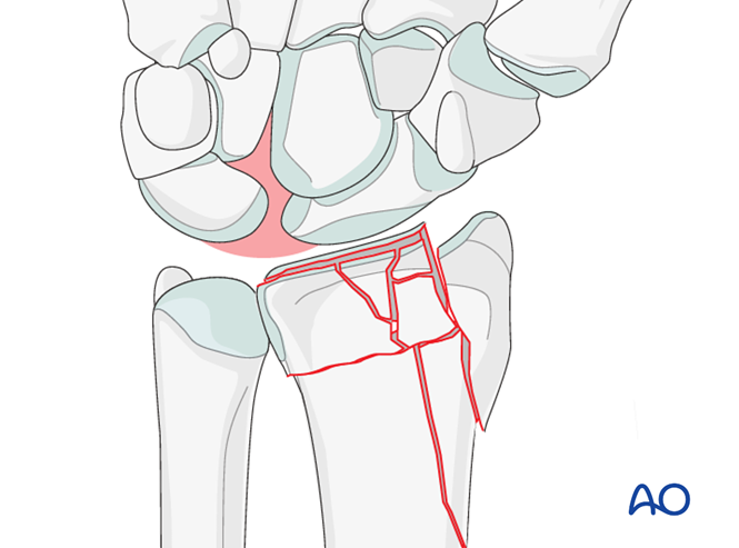 ORIF - Palmar bridge plate for Complete multifragmentary fracture of ...