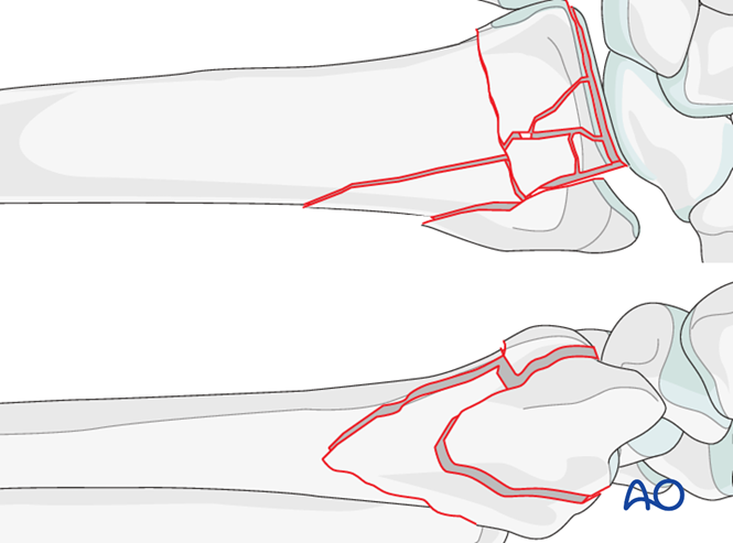 ORIF - Palmar bridge plate for Complete multifragmentary fracture of ...