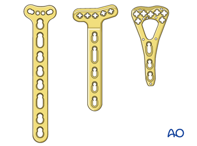 ORIF - Palmar bridge plate for Complete simple articular, fragmented ...