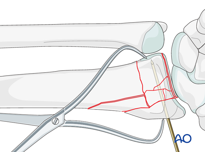 ORIF - Palmar bridge plate for Complete multifragmentary fracture of ...