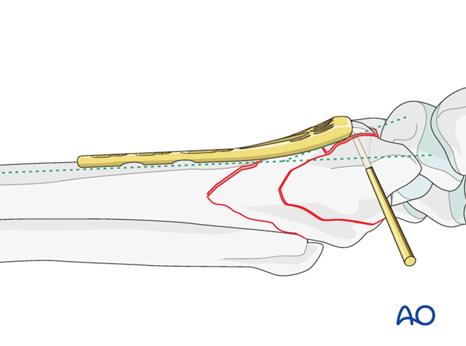 ORIF - Palmar bridge plate for Complete multifragmentary fracture of ...