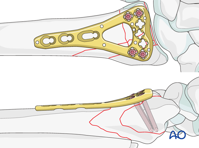ORIF - Palmar bridge plate for Complete multifragmentary fracture of ...