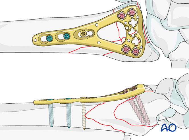 ORIF - Palmar bridge plate for Complete multifragmentary fracture of ...