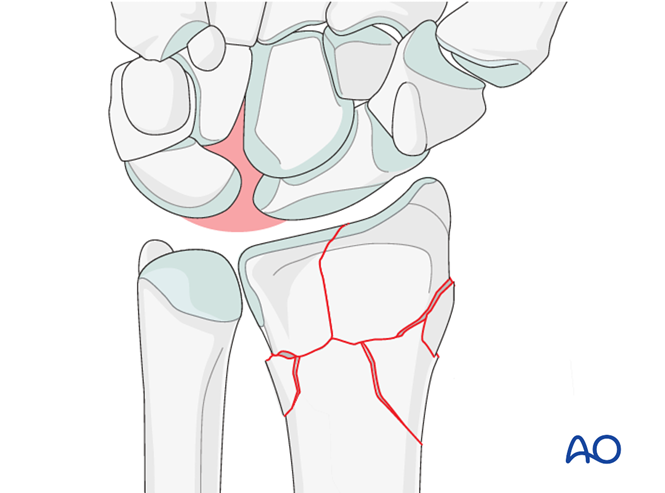 ORIF - Palmar bridge plate for Complete simple articular, fragmented ...