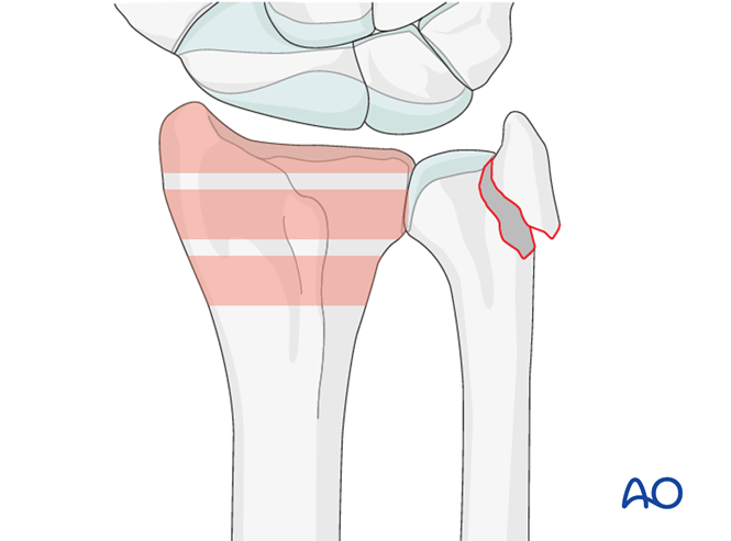 ORIF - Radial column plate for Partial articular, sagittal ...
