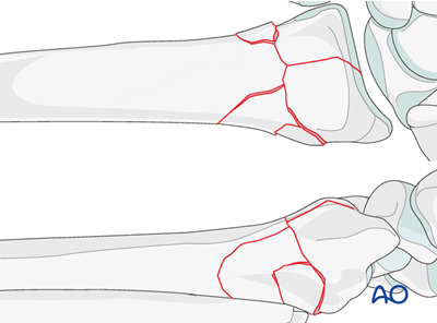 ORIF - Palmar bridge plate for Complete simple articular, fragmented ...