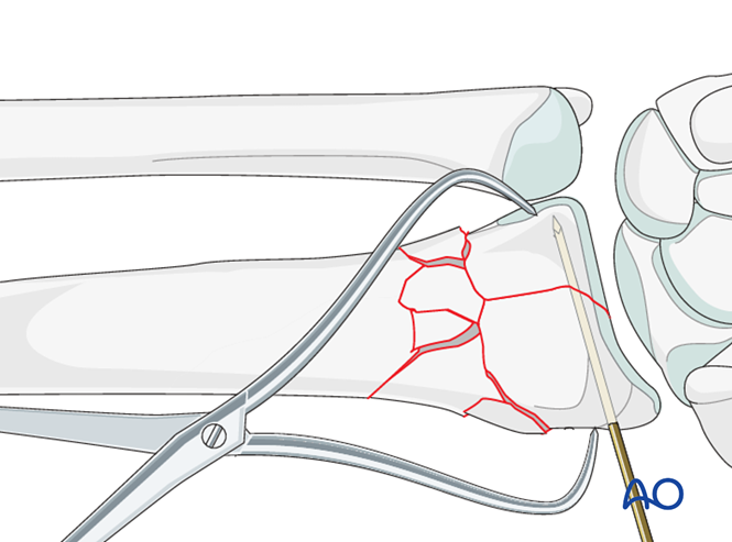 ORIF - Palmar bridge plate for Complete simple articular, fragmented ...