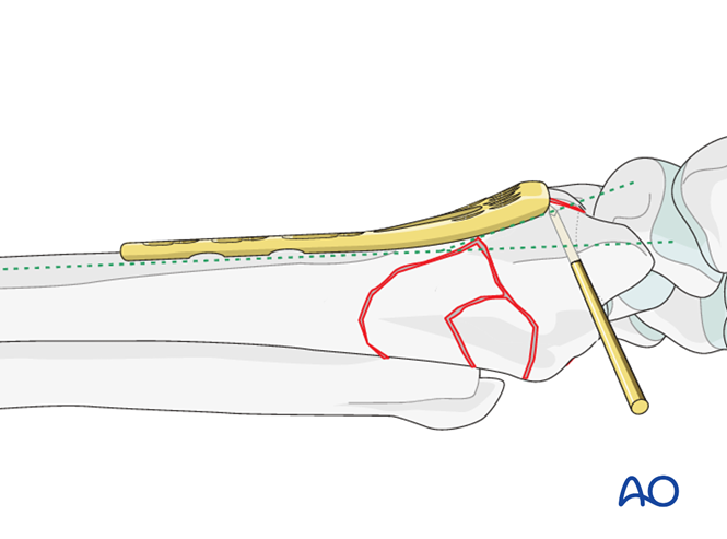 ORIF - Palmar bridge plate for Complete simple articular, fragmented ...