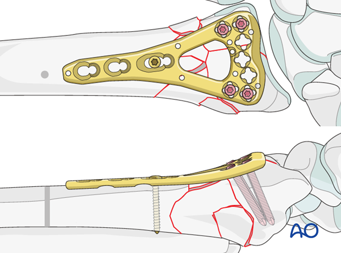 ORIF - Palmar bridge plate for Complete simple articular, fragmented ...