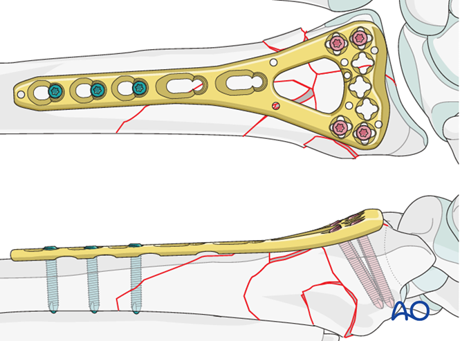 ORIF - Palmar bridge plate for Complete simple articular, fragmented ...