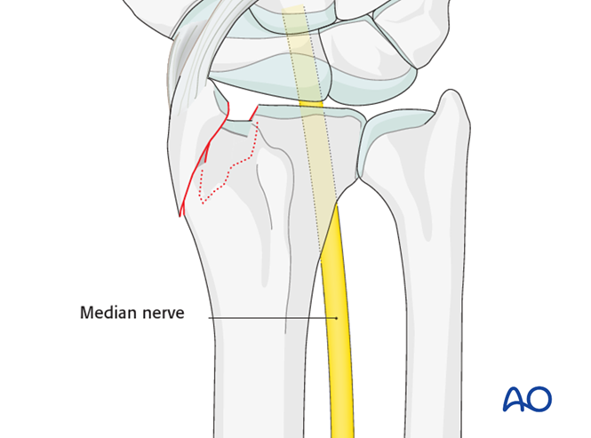 ORIF - Radial column plate for Partial articular, sagittal ...