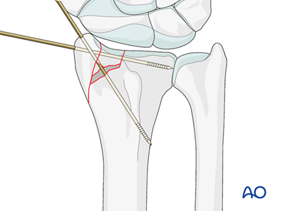 ORIF - Radial column plate for Partial articular, sagittal ...