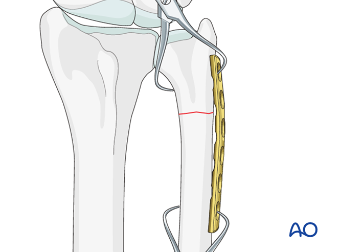ORIF - Compression plate for Extraarticular simple fracture of the ulna