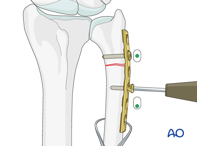 ORIF - Compression plate for Extraarticular simple fracture of the ulna