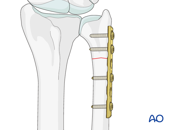 ORIF - Compression plate for Extraarticular simple fracture of the ulna