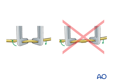 ORIF - Radial column plate for Partial articular, sagittal simple ...