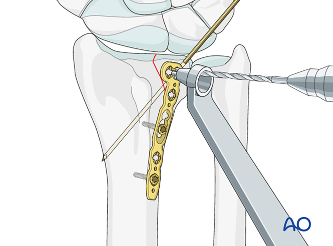 ORIF - Dorsal plate for Partial articular, sagittal fracture of the ...