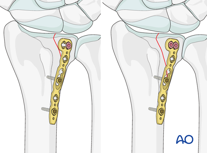 ORIF - Dorsal plate for Partial articular, sagittal fracture of the ...