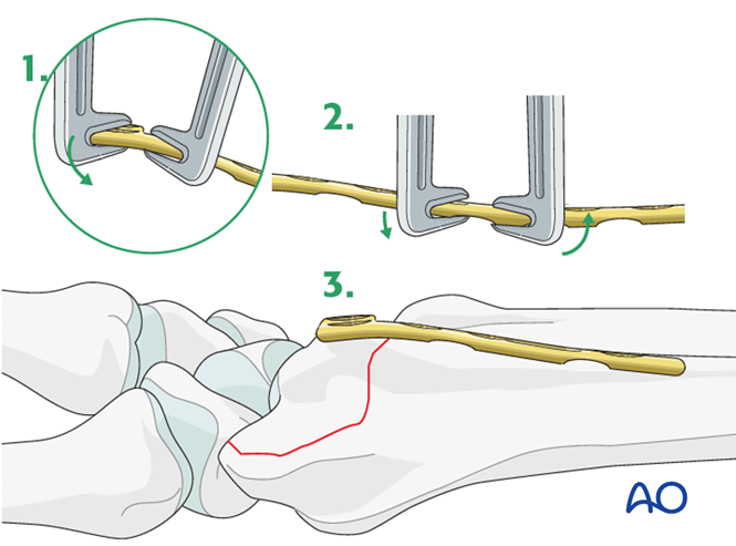 ORIF - Dorsal plate for Partial articular, simple fracture of the ...