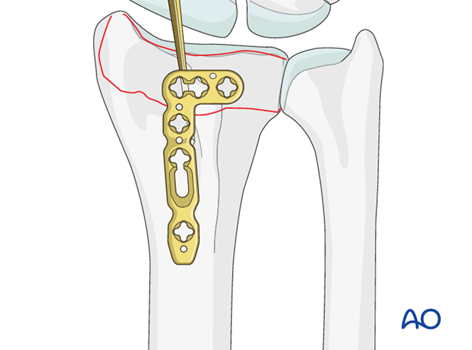 ORIF - Dorsal plate for Partial articular, simple fracture of the ...