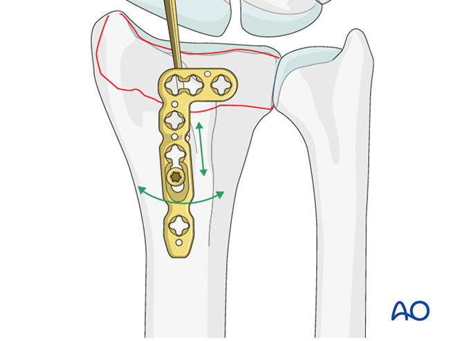 ORIF - Dorsal plate for Partial articular, simple fracture of the ...