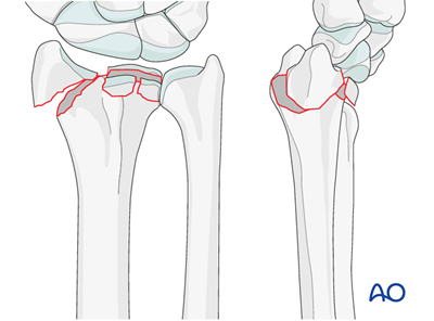 ORIF - Dorsoradial double plate for Partial articular, fragmentary ...